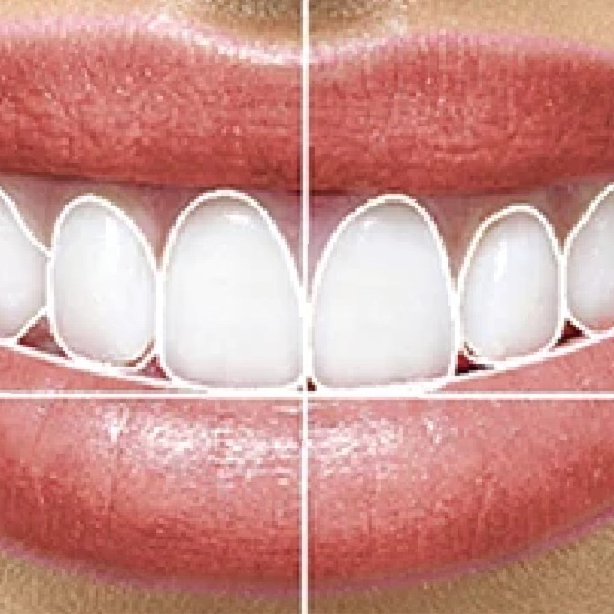 Lammina Dental Veneers with Six Month Smiles