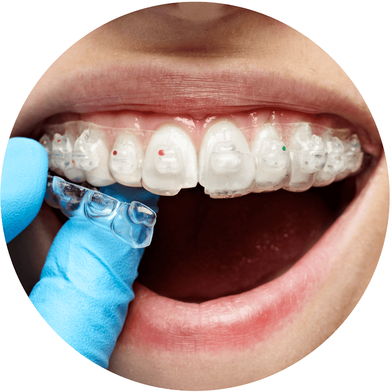Guided Ortho for Dentists | Six Month Smiles