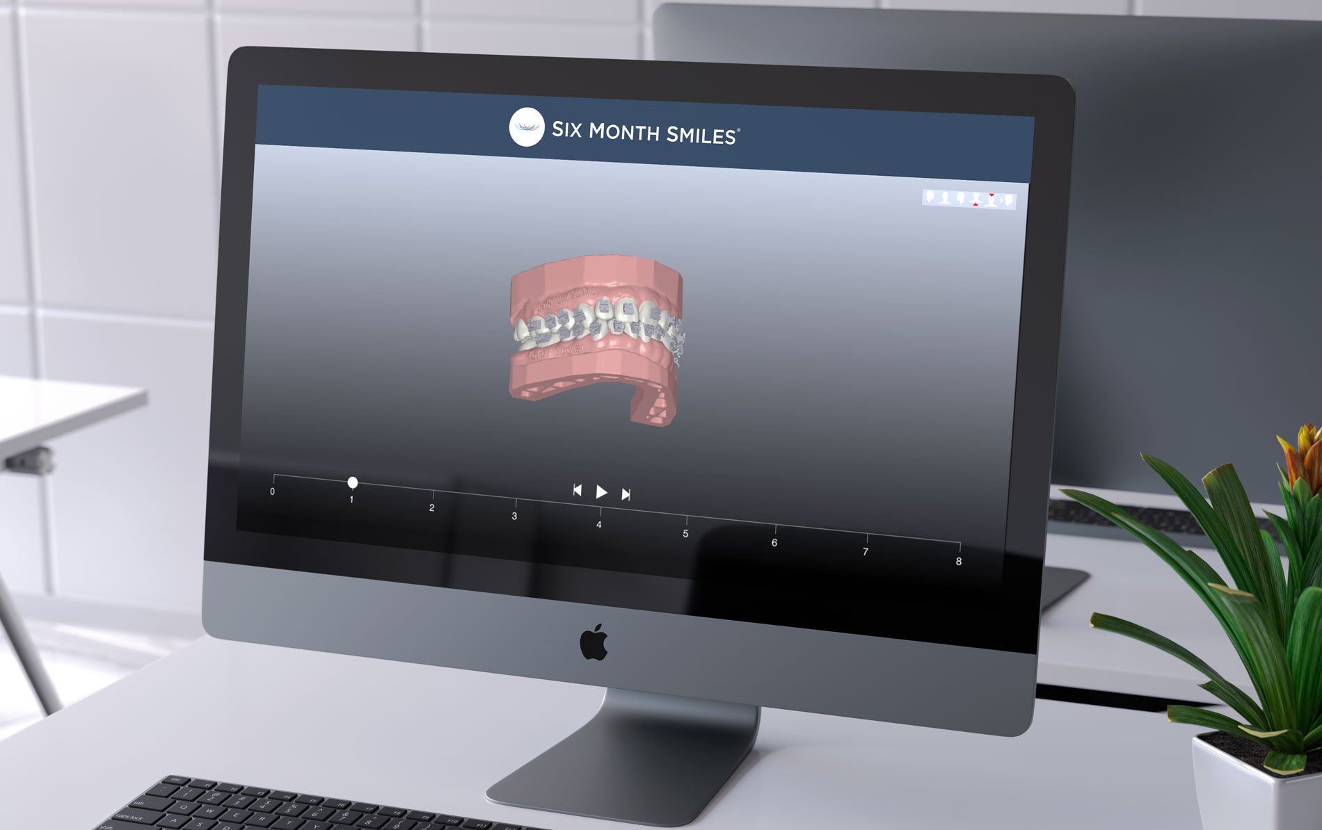 Guided Orthodontics Treatment Planning with CONFIDEX™