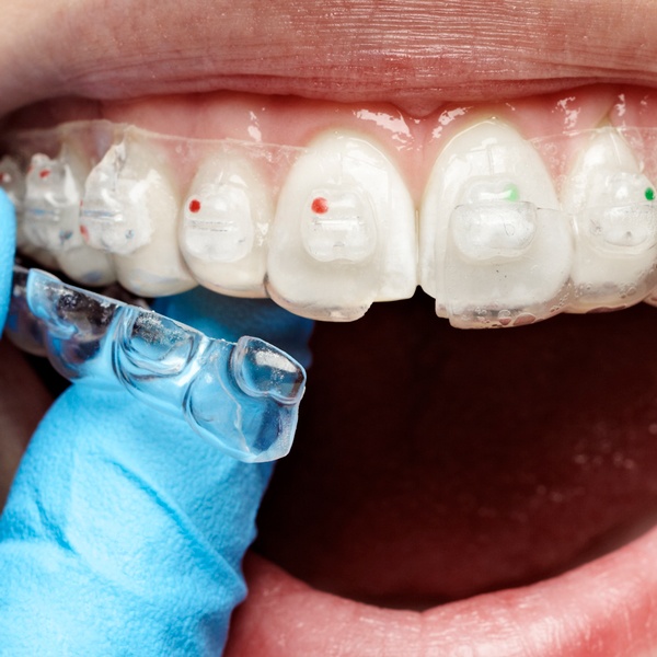 Offer Fast Orthodontics For Your Adult Patients