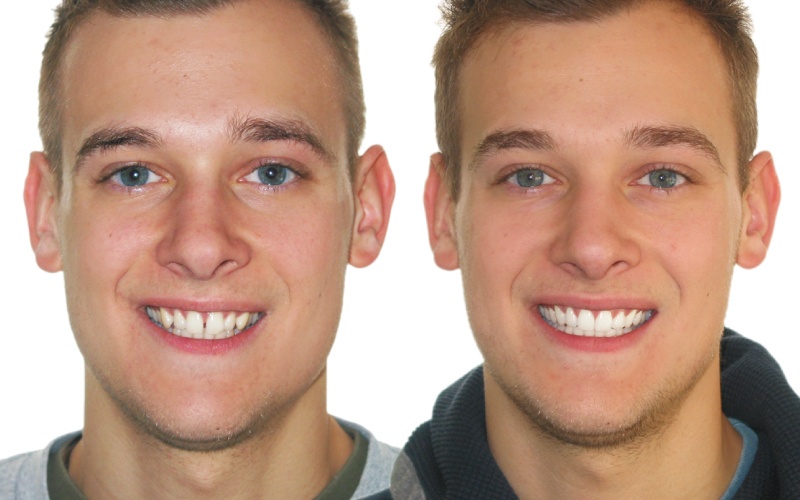 Incredible Adult Braces Before and After Comparisons
