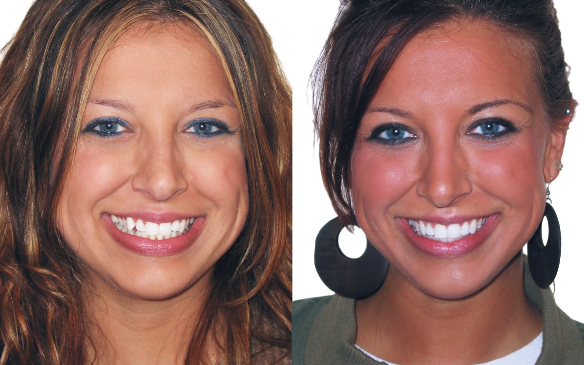 Incredible Adult Braces Before and After Comparisons