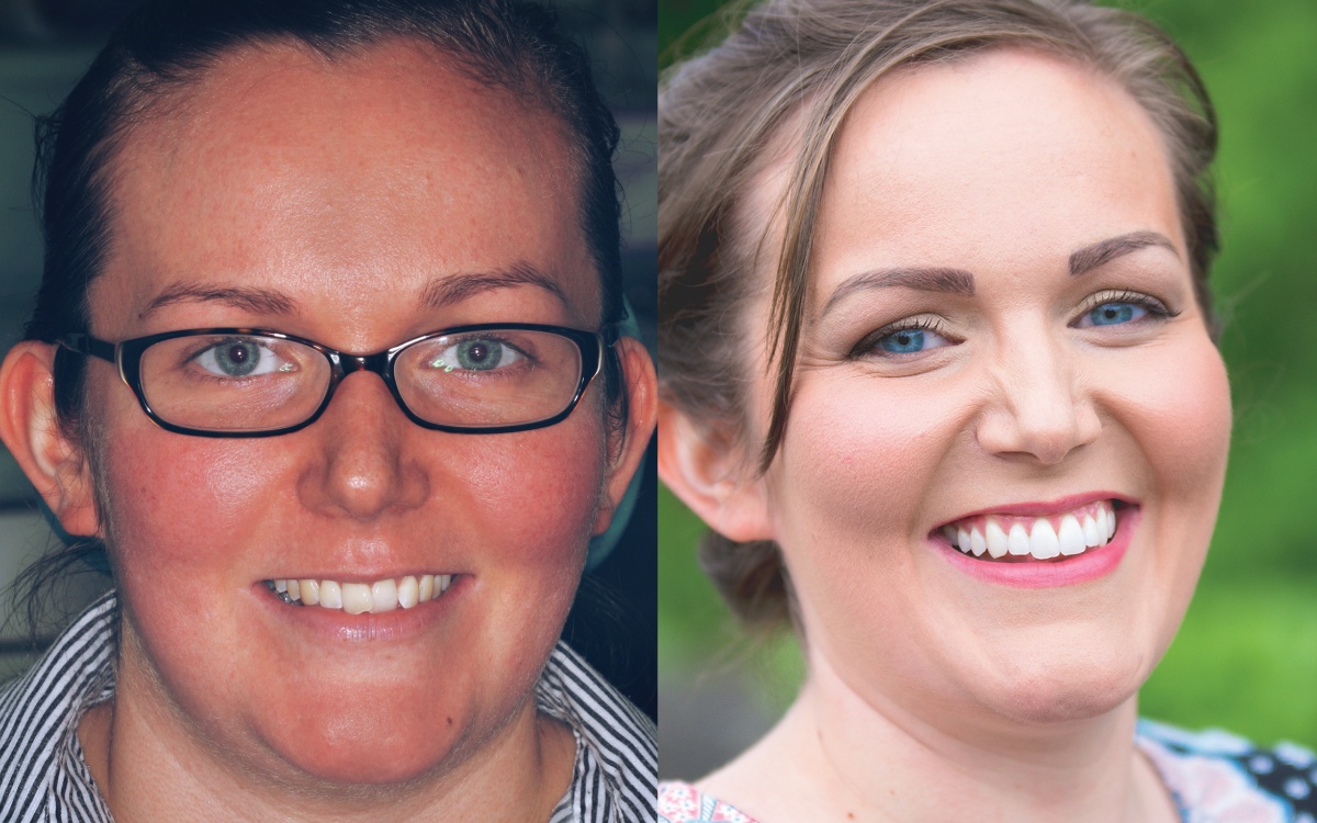 Incredible Adult Braces Before and After Comparisons