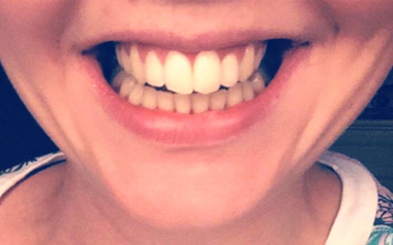 REAL Six Month Smiles Success Stories