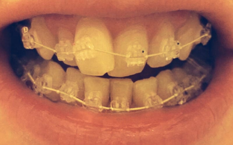REAL Six Month Smiles Success Stories
