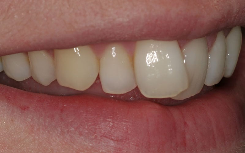 REAL Six Month Smiles Success Stories