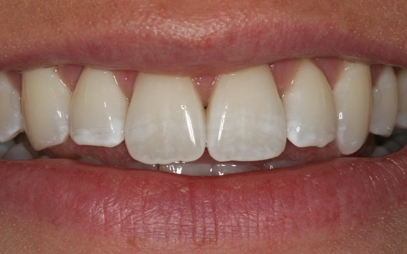 REAL Six Month Smiles Success Stories