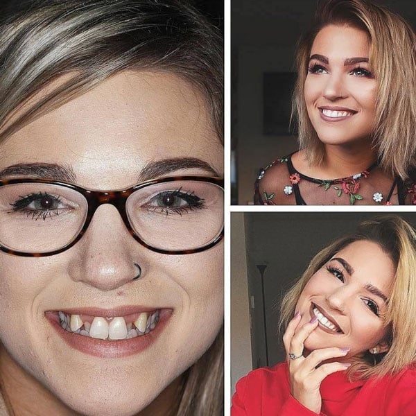 Six Month Smiles - Straight Teeth in Less Time