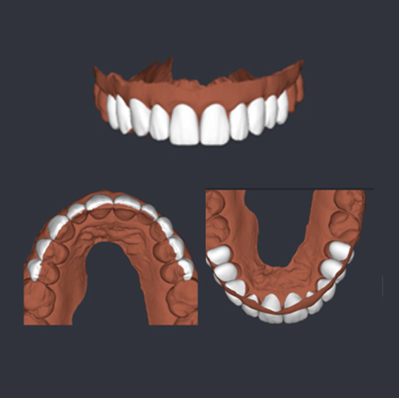 Lammina Non-Invasive Veneers by Six Month Smiles